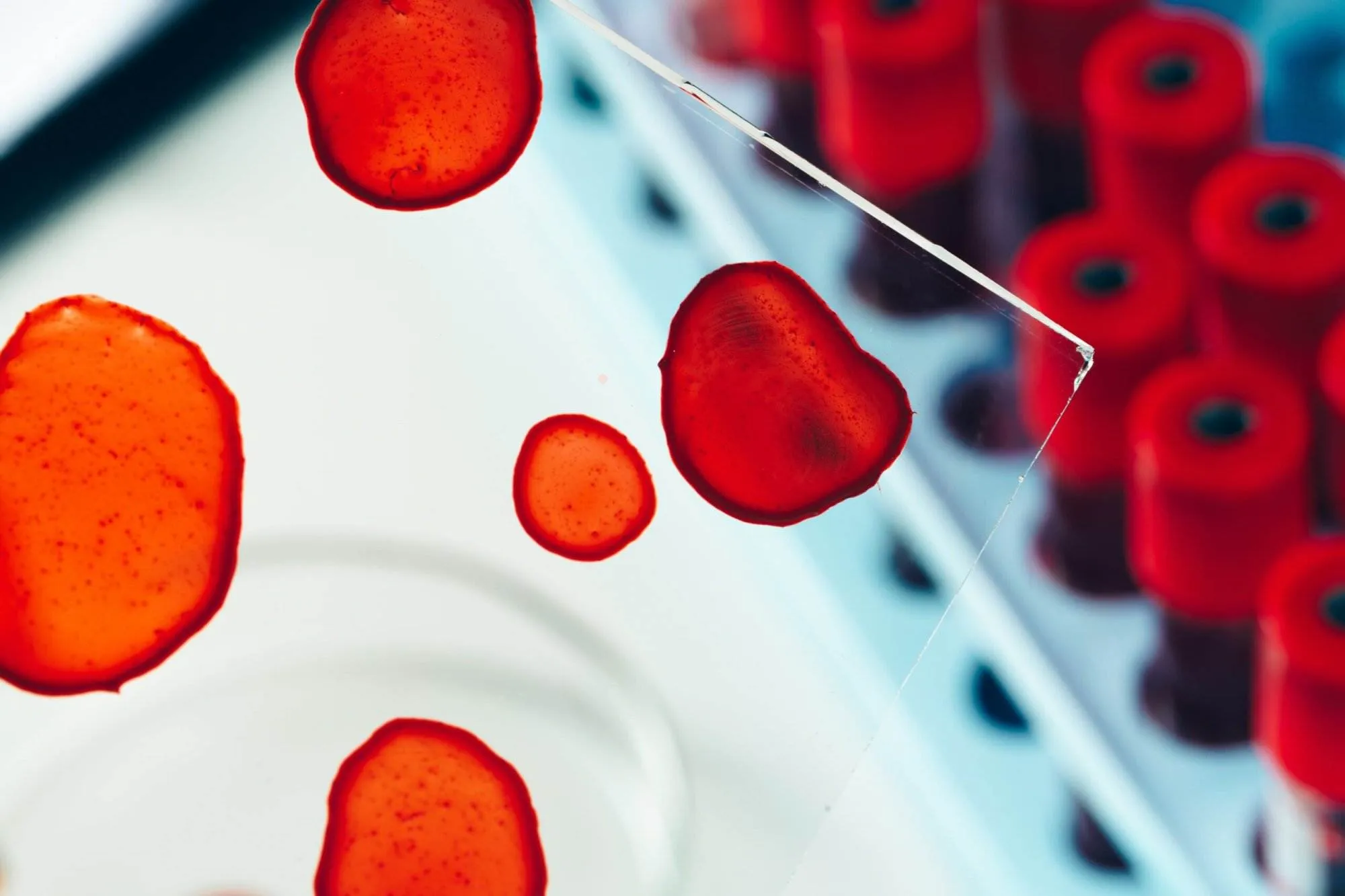 Understanding Low Platelet Count: Causes and Treatments